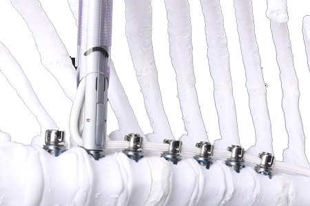 The Tether™ Vertebral Body Tethering System | Orb Medical