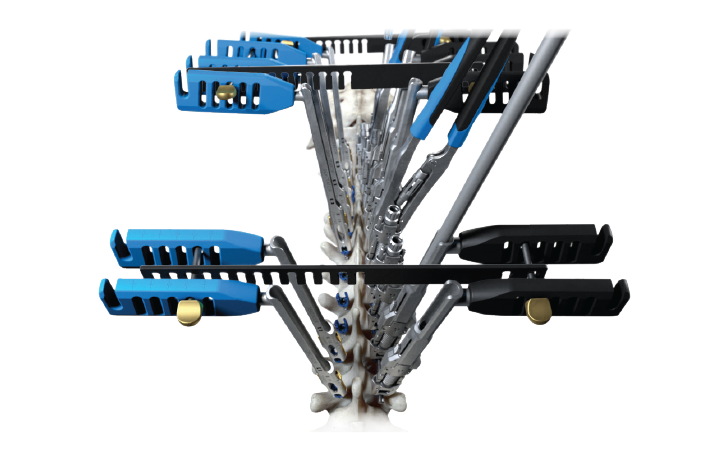Vital™ Deformity Spinal Fixation System | Orb Medical