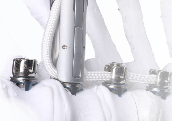 The Tether™ Vertebral Body Tethering System | Orb Medical